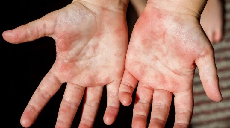 Apa itu Dishidrosis: Kondisi Kulit yang Menyebabkan Lepuh dan Gatal